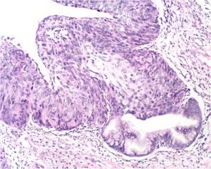 Cancer cérvicouterino - Cáncer y Oncología Medina